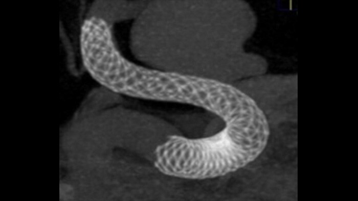 Neurocirugía guiada por imágenes | Philips