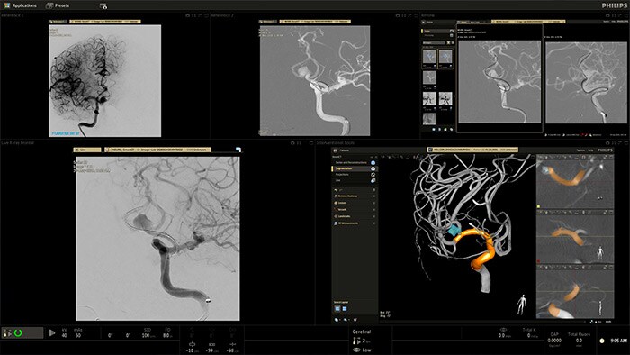 Sala de intervencionismo integrada con Azurion | Philips